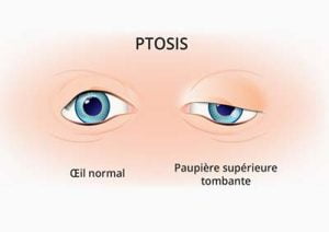 Ptosis: Comprendre, Prévenir et Corriger l’Affaissement des Paupières