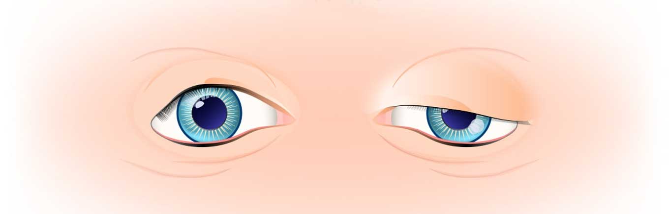 Ptosis: Comprendre, Prévenir et Corriger l’Affaissement des Paupières
